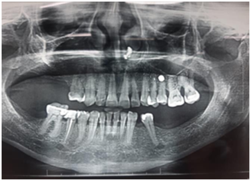 Long Standing Intra-Oral Foreign Body: A Rare Case Report