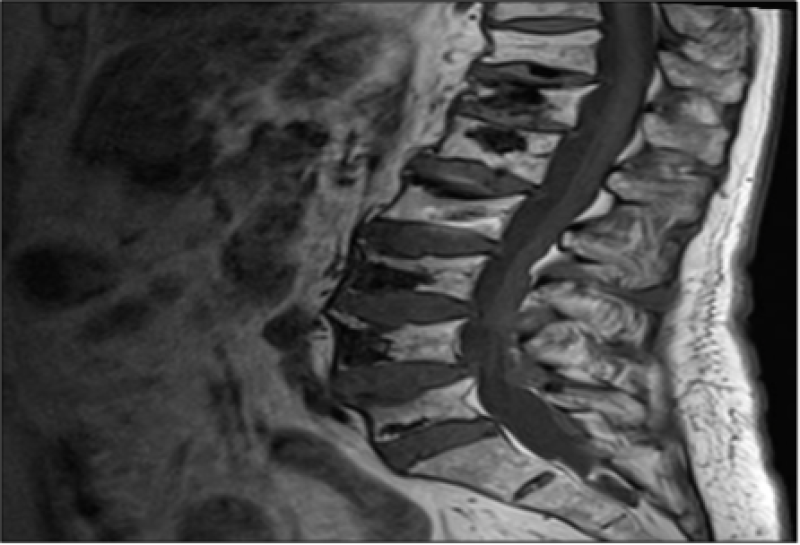 Balloon Kyphoplasty for Chronic Compression Fracture: A Case Series