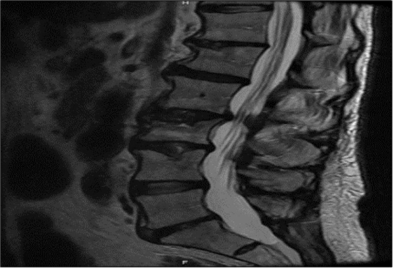 Balloon Kyphoplasty for Chronic Compression Fracture: A Case Series